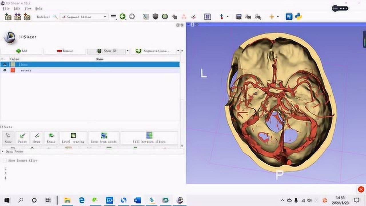 CTA重建之mimics和3D slicer 流程_腾讯视频