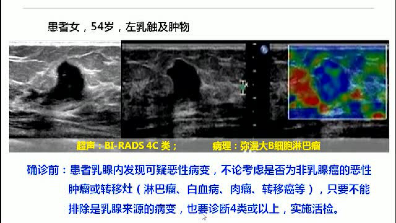 乳腺BI-RADS分类解读-李颖嘉_腾讯视频