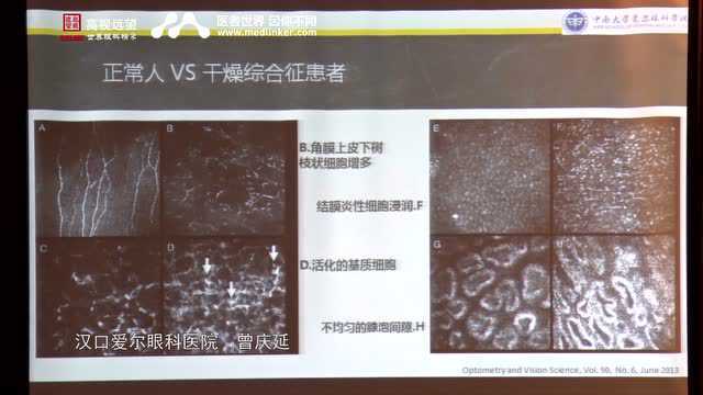 海德堡HRT3－共焦激光角膜显微镜在干眼症诊疗中的应用进展_腾讯视频