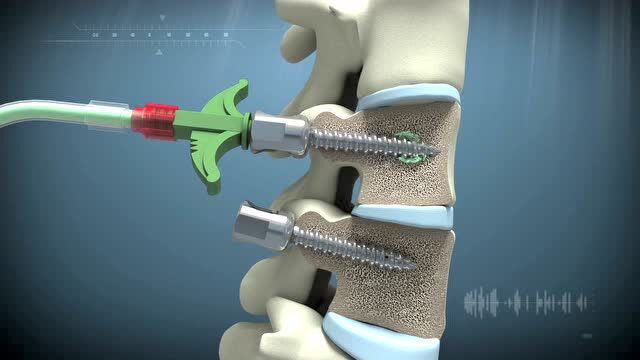 骨水泥填充器套件《中空椎弓根钉》_腾讯视频