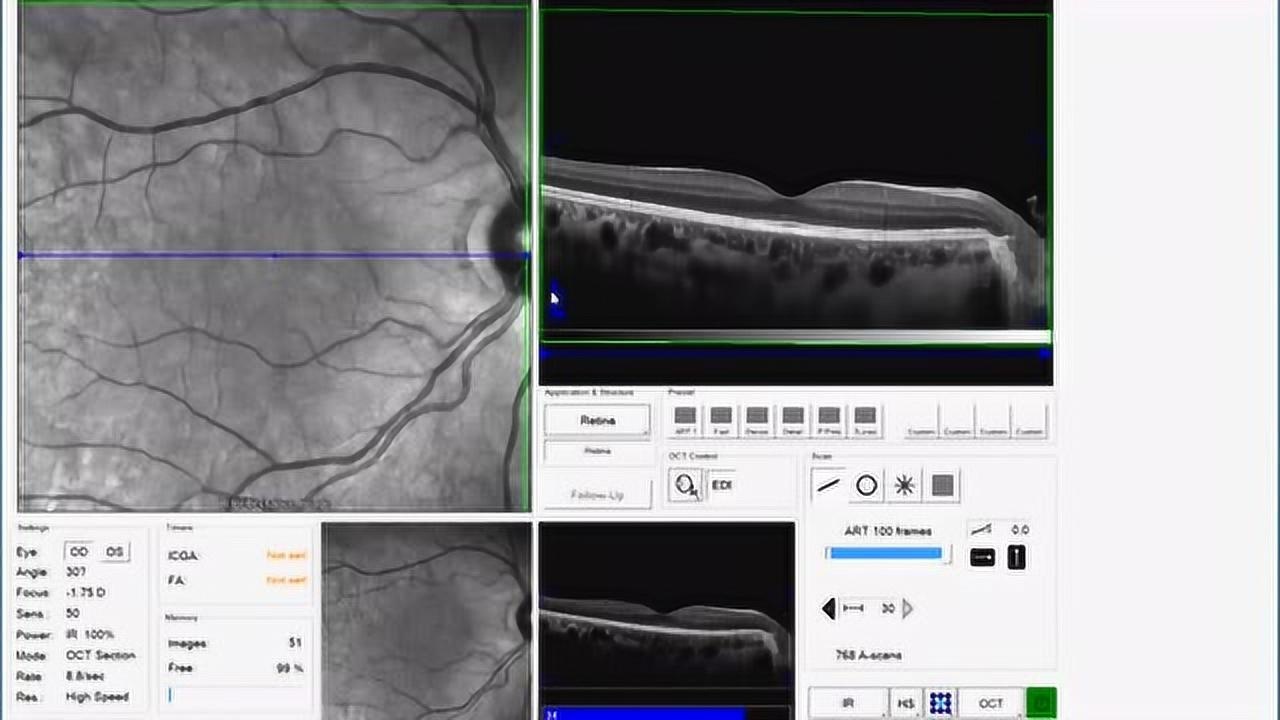 海德堡OCT临床应用指南（三）进阶操作2.EDI操作方法_高清1080P在线观看平台_腾讯视频