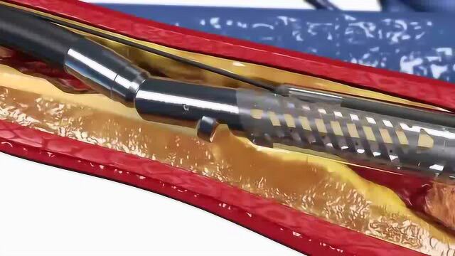 斑块旋切-手术示意图_腾讯视频