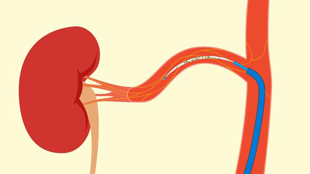 RDN手术演示_高清1080P在线观看平台_腾讯视频