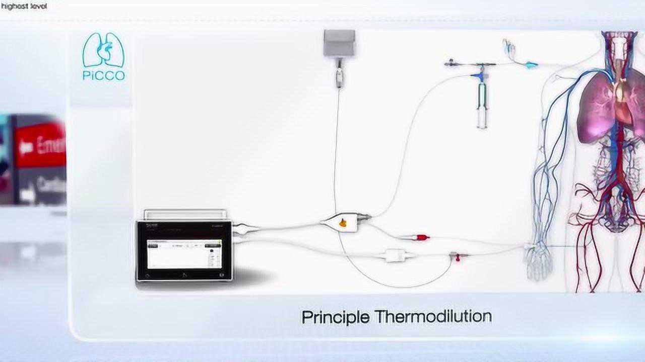 PiCCO平台血流动力学监测应用介绍_腾讯视频