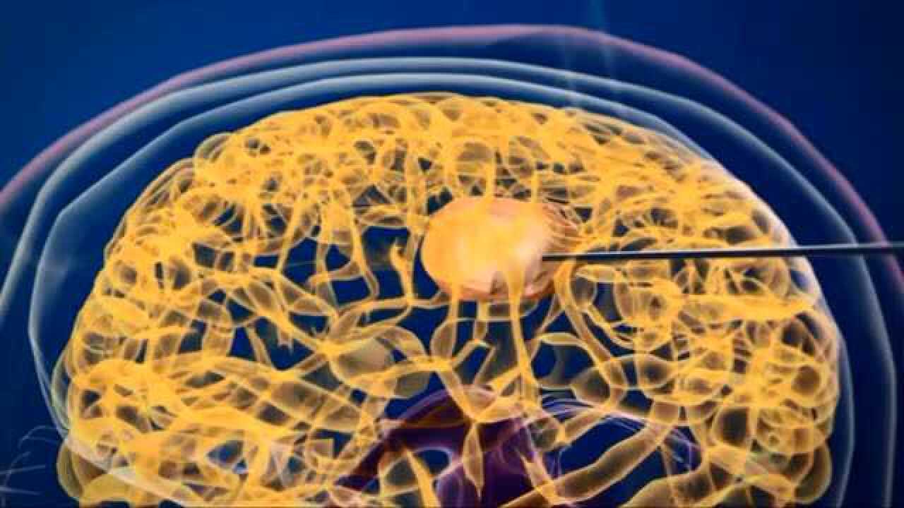 Magforce超顺磁性纳米颗粒进行肿瘤热疗_高清1080P在线观看平台_腾讯视频