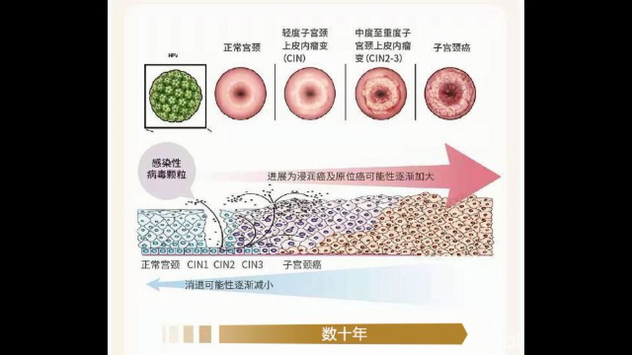 正常宫颈怎么变成宫颈癌南京华肤医院 腾讯视频