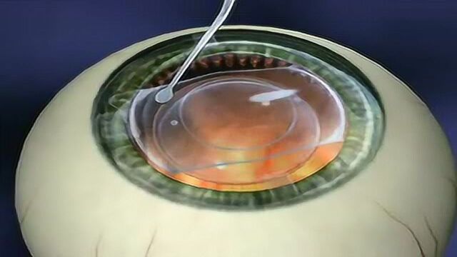 ICL手术演示_腾讯视频