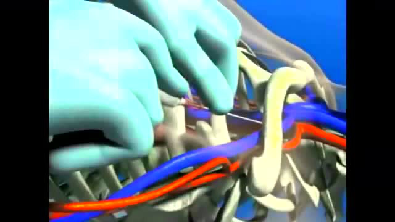 3.centralvenouscatheter(CVC)-高级创伤生命支持视频教程_高清1080P在线观看平台_腾讯视频