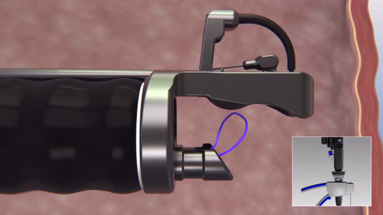 OverStitch内镜缝合系统_高清1080P在线观看平台_腾讯视频