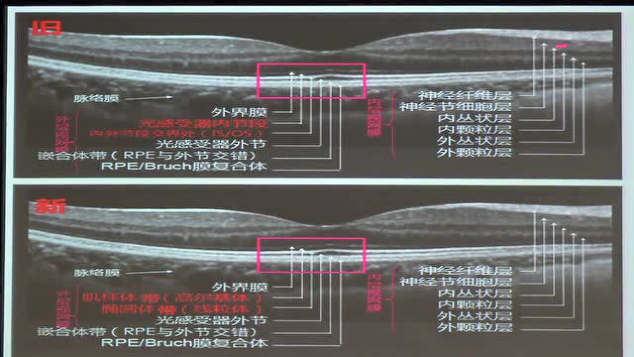 OCT图像的解读方法和技巧_高清1080P在线观看平台_腾讯视频