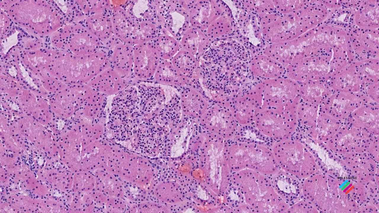 Milestone公司PrestoCHILL操作——穿刺_腾讯视频