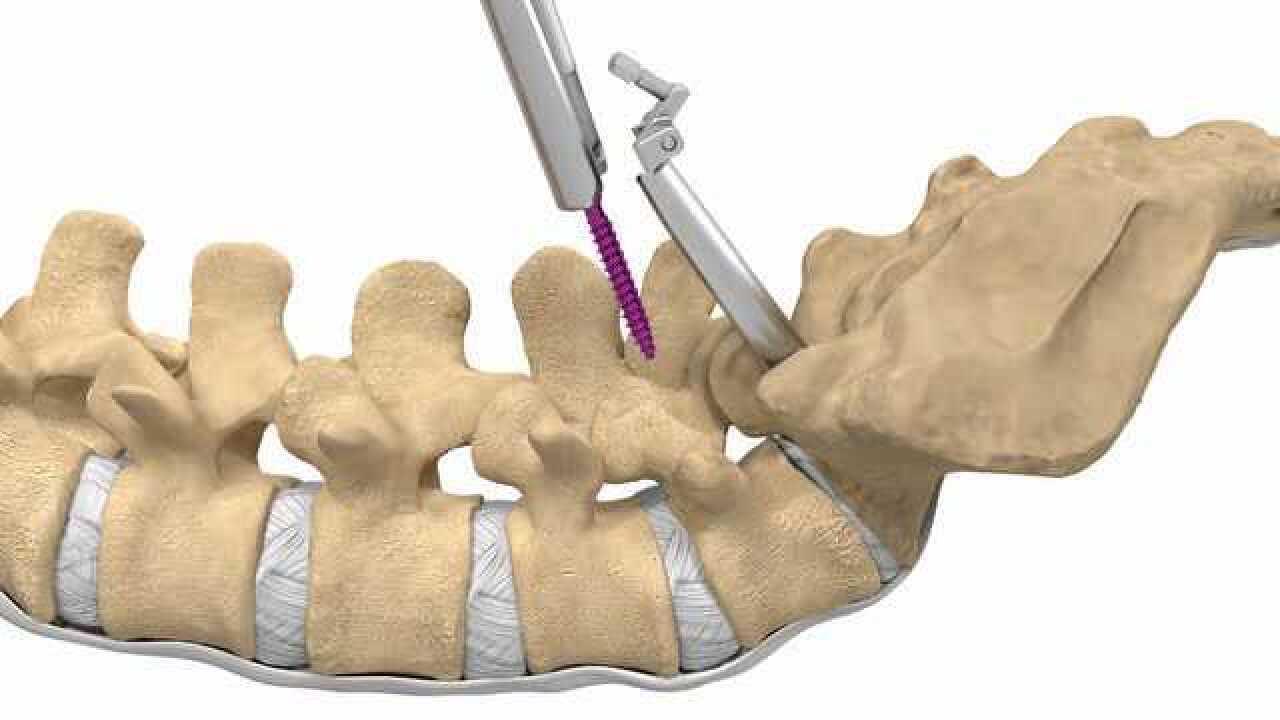 TLIF经椎间孔腰椎融合器系统_高清1080P在线观看平台_腾讯视频