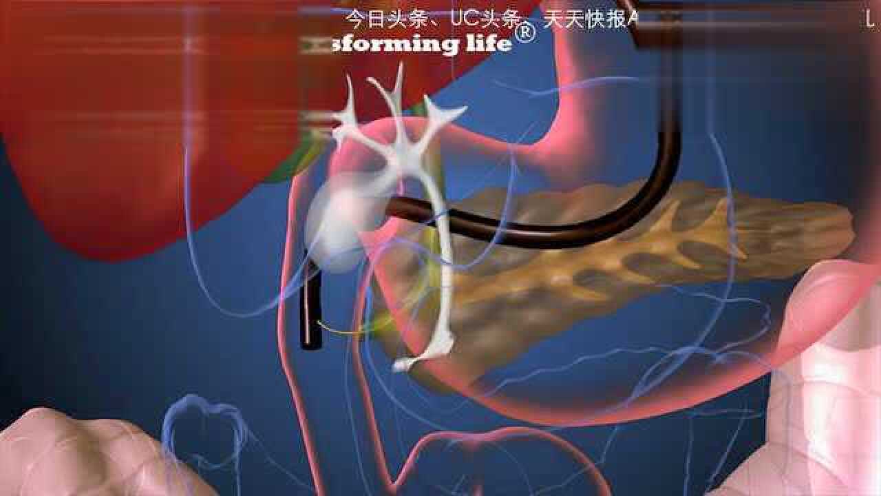 医学科普短片：ERCP演示及其适应证_高清1080P在线观看平台_腾讯视频