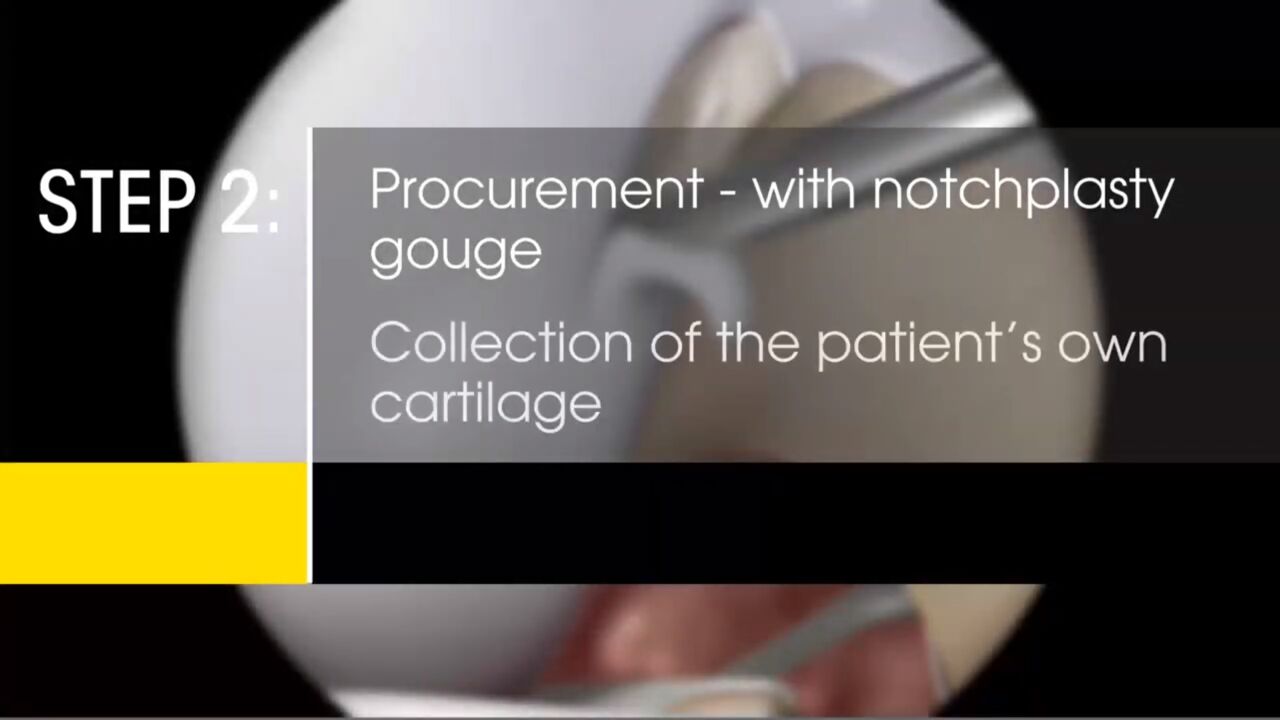 MACIsurgicalanimationstep2-Biopsyprocurementwithnotchplastygouge_高清 ...