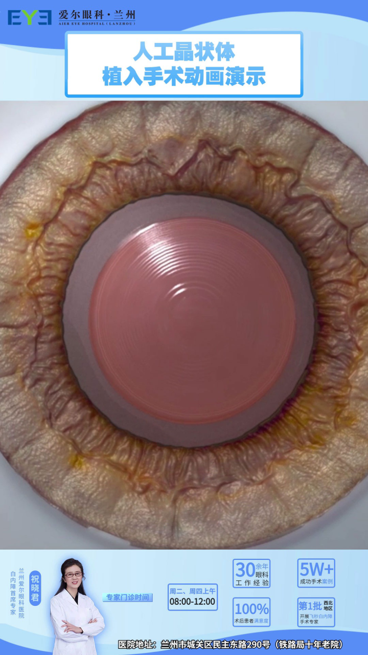 白内障手术人工晶体植入动画演示_腾讯视频