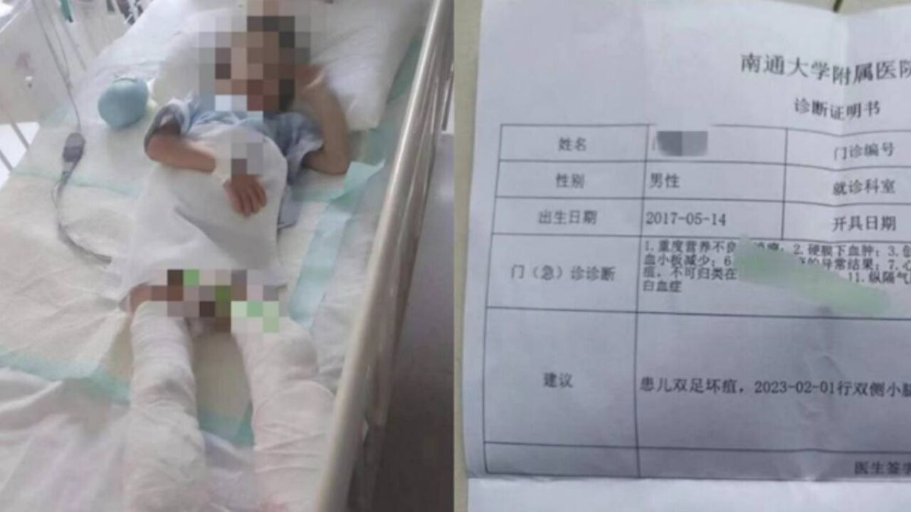 男孩被生母虐待致截肢，父亲再发声：腿没保住，希望能保住眼睛腾讯视频