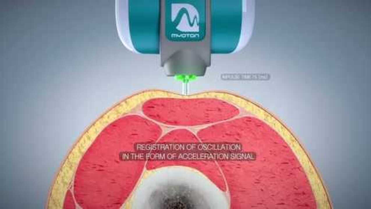 MyotonPRO工作原理_高清1080P在线观看平台_腾讯视频