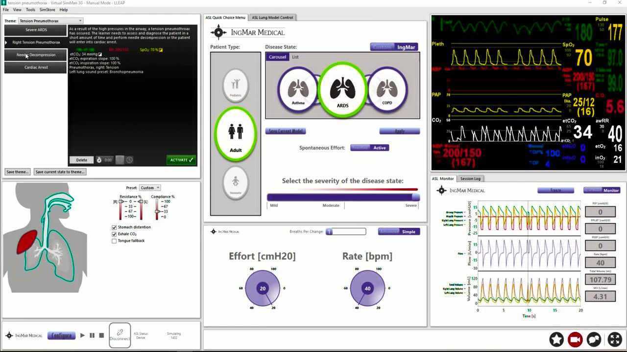 使用ASL5000模拟肺解决方案管理气胸_高清1080P在线观看平台_腾讯视频