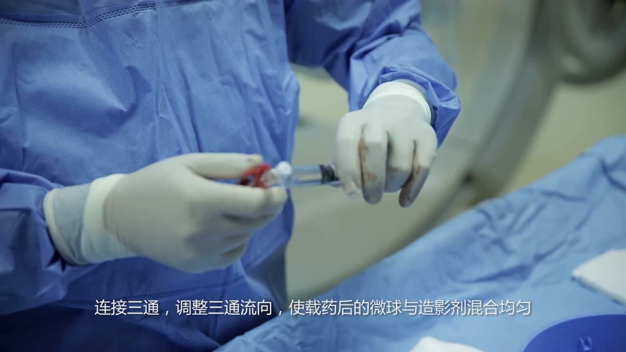 CalliSpheres可载药栓塞微球临床应用实例_高清1080P在线观看平台_腾讯视频