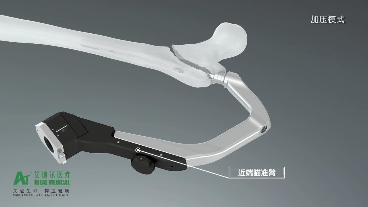 艾迪尔医疗 伽玛交锁髓内钉IV（PFN）_腾讯视频