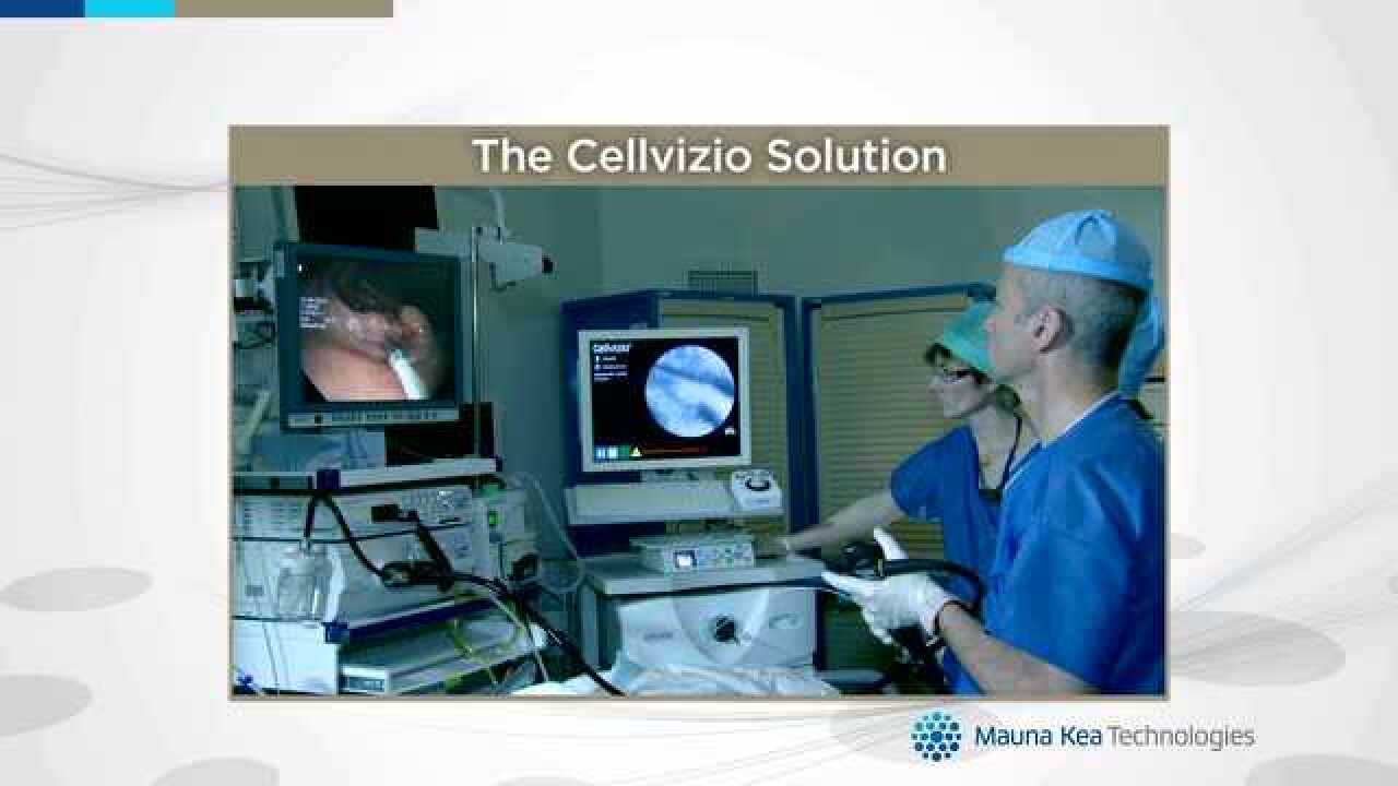 Cellvizio，全球唯一的探头式共聚焦激光显微内镜_高清1080P在线观看平台_腾讯视频