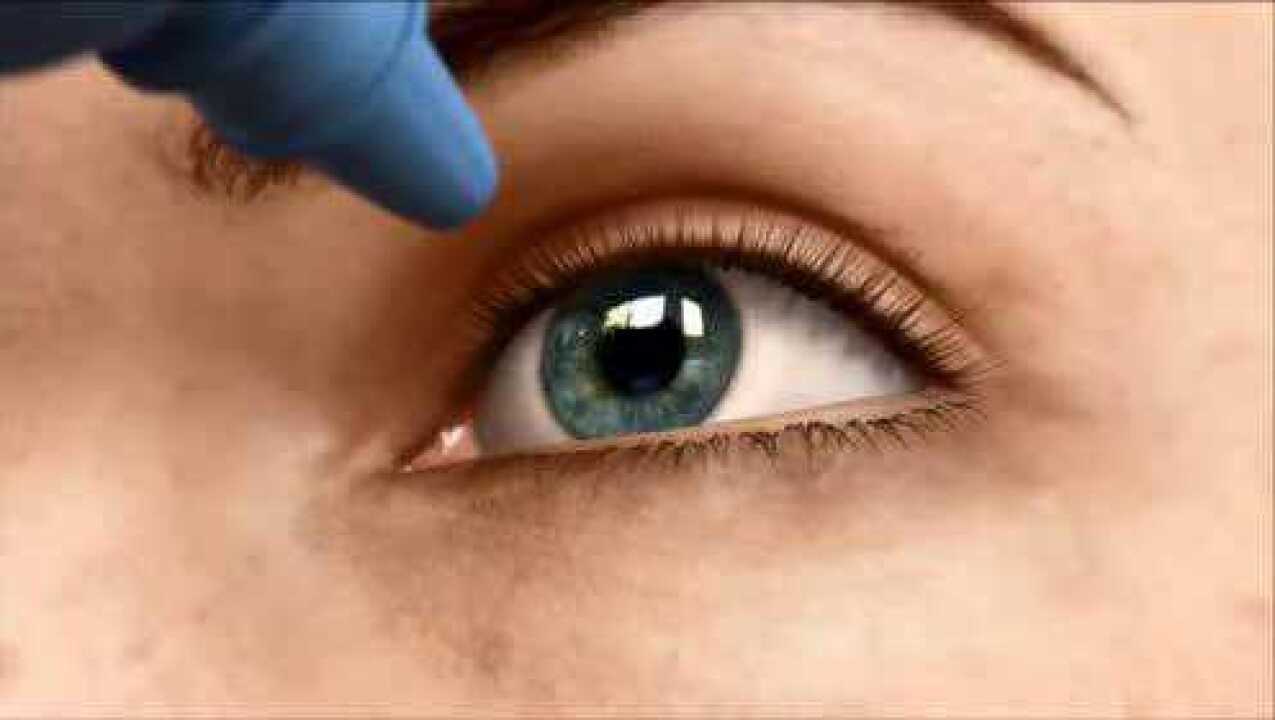 EVOICL手术过程介绍_腾讯视频