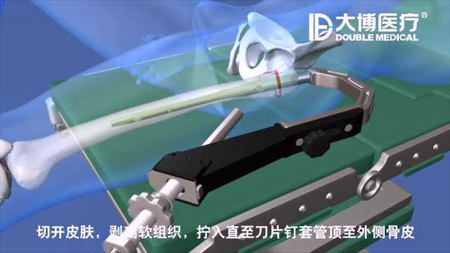 PFNA操作视频_腾讯视频