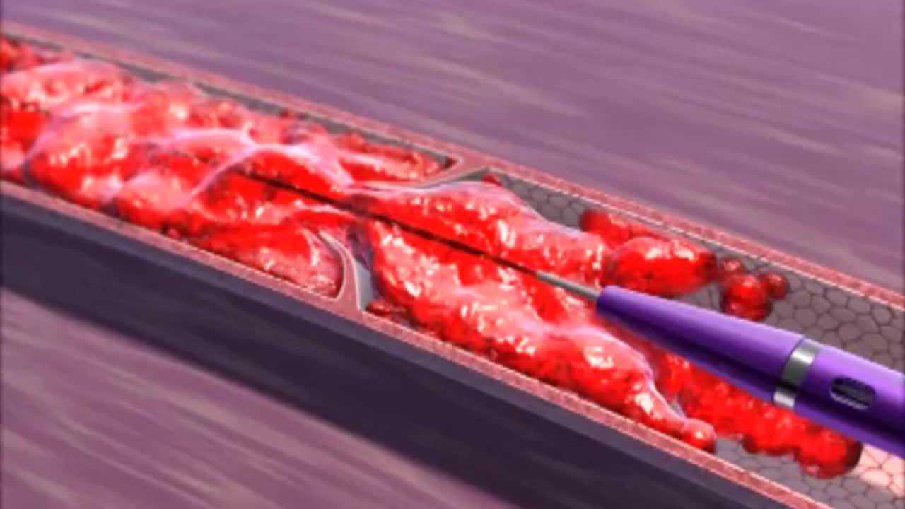 AngioJet模拟视频版_腾讯视频