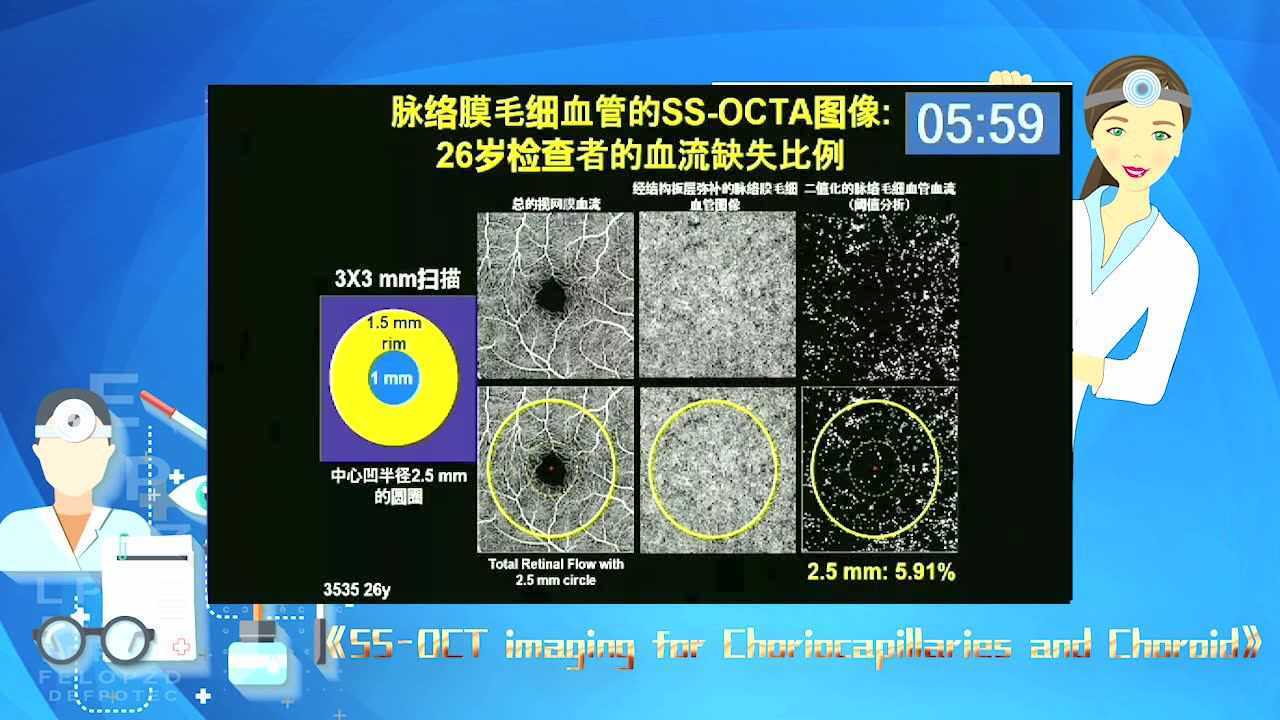 Rosenfeld-SS-OCT的脉络膜毛细血管层及脉络膜影像_高清1080P在线观看平台_腾讯视频