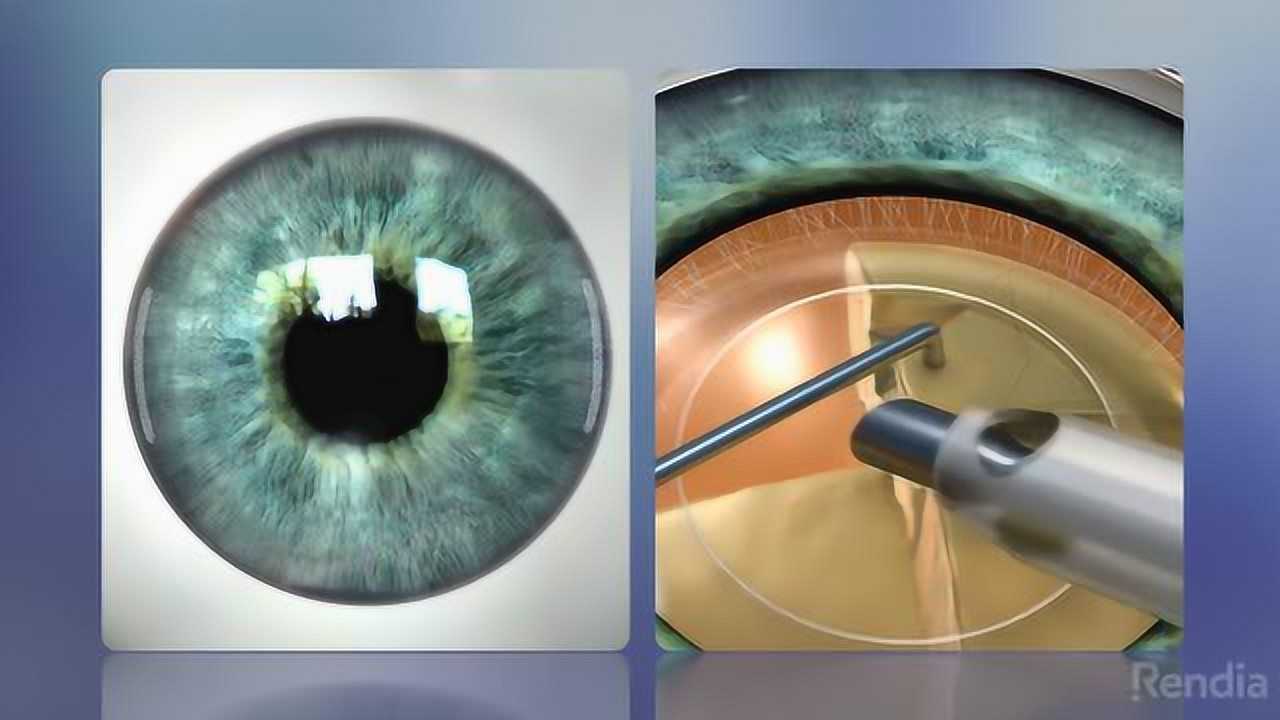 CornealRelaxingIncisions（角膜松解切开）_高清1080P在线观看平台_腾讯视频