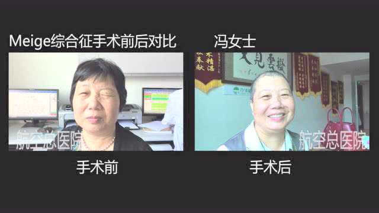 Meige综合征视频对比_高清1080P在线观看平台_腾讯视频