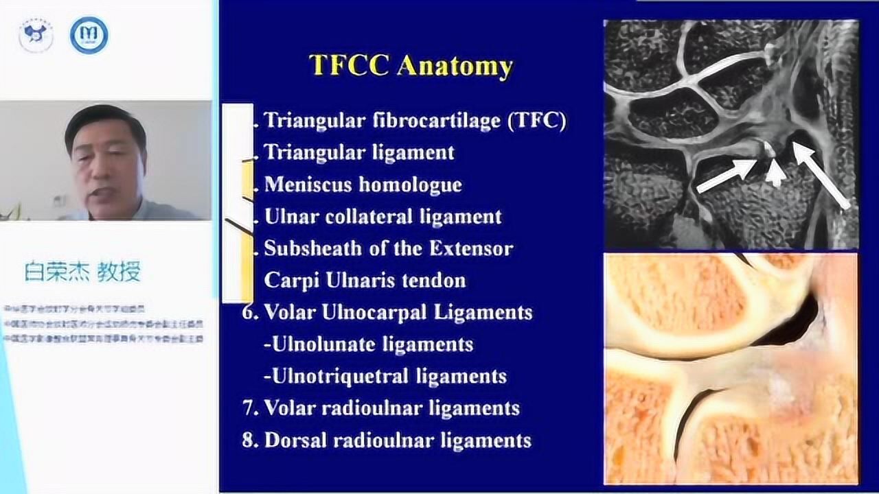 TFCC损伤分型及MRI诊断_高清1080P在线观看平台_腾讯视频