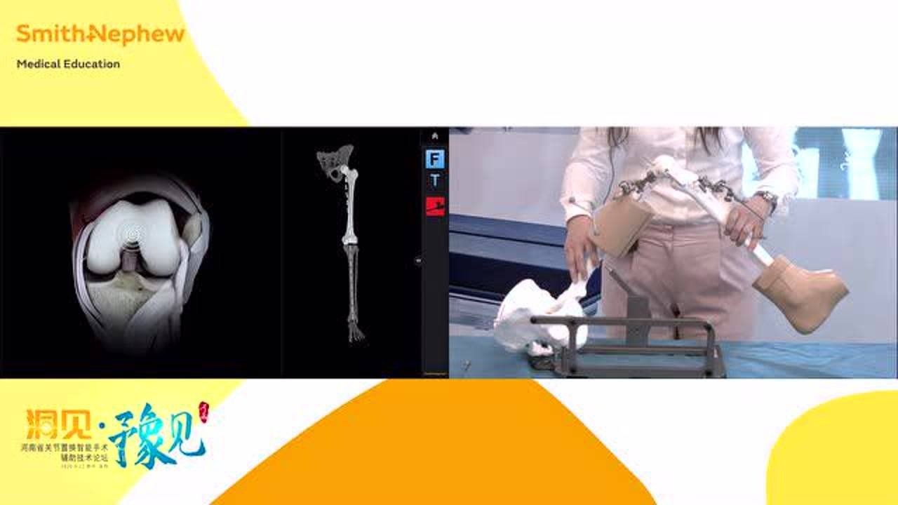 BrainlabKnee3工作流程演示_高清1080P在线观看平台_腾讯视频