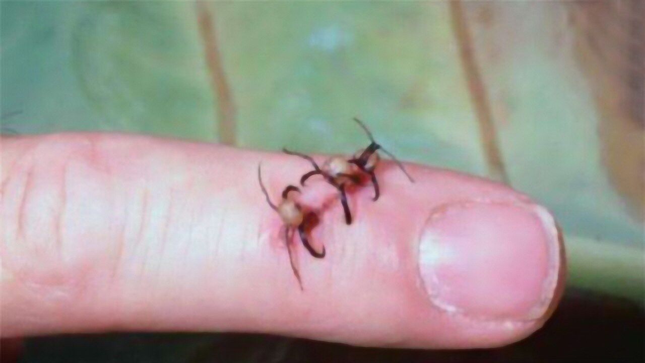 令人惊奇的医疗手法！用行军蚁缝合伤口，这勇气令人佩服_腾讯视频