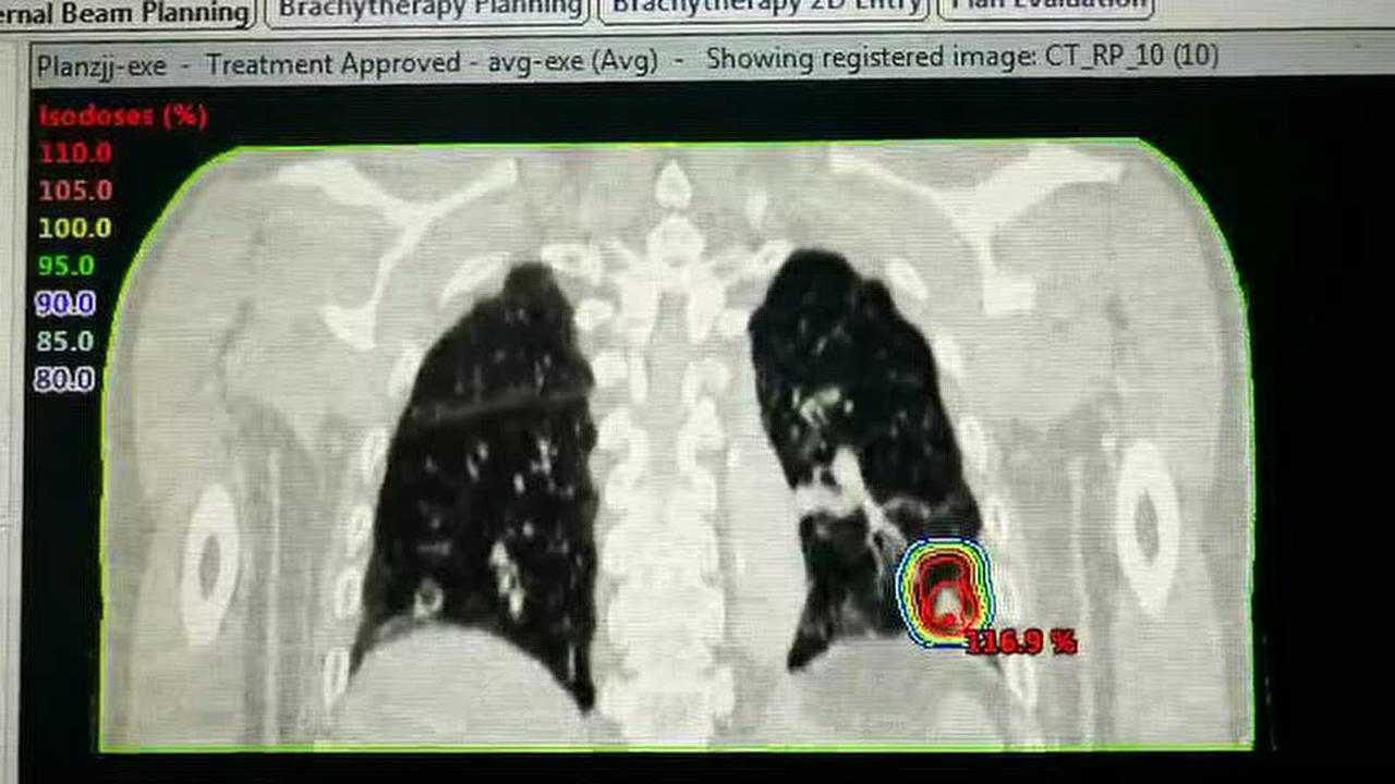 4DCT显示照射靶区范围内肺癌病灶的运动轨迹_高清1080P在线观看平台_腾讯视频