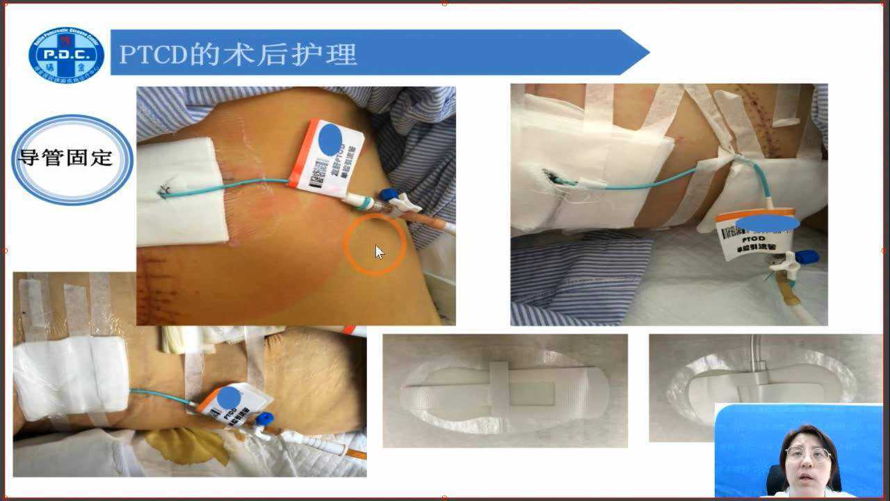 外科常见引流管及PTCD管的护理（韦筱燕）_高清1080P在线观看平台_腾讯视频
