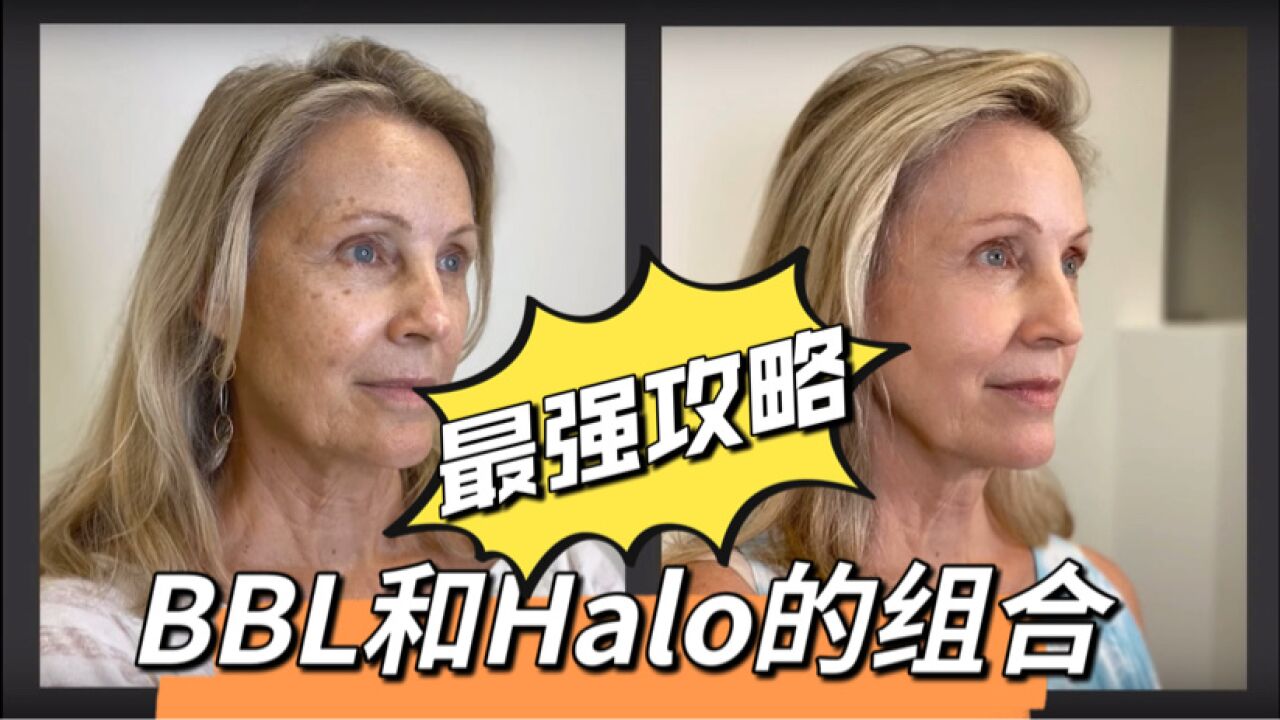 疤痕克星！#来自美国的最新科技#坐标弗罗里达 #BBLhero#BBLplus#BBL+_腾讯视频