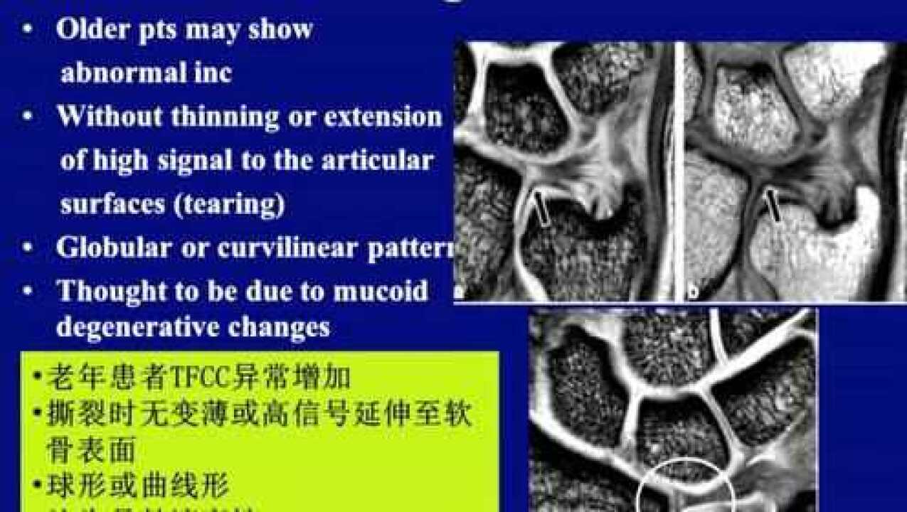 三角纤维软骨复合体（TFCC）解剖及损伤MR表现_高清1080P在线观看平台_腾讯视频