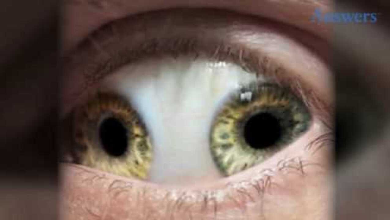 双瞳孔的人和正常瞳孔的人，看到的世界有什么不同？高清1080p在线观看平台腾讯视频