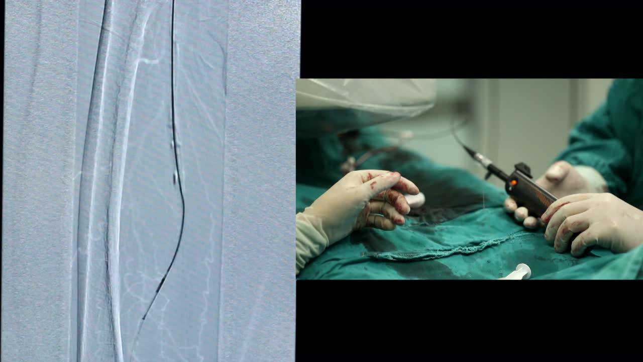 turbohawk斑块旋切系统_高清1080P在线观看平台_腾讯视频