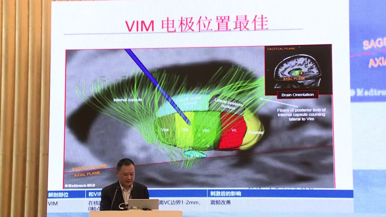 牛朝诗：Vim-DBS靶点立体定向解剖、电生理特征_高清1080P在线观看平台_腾讯视频