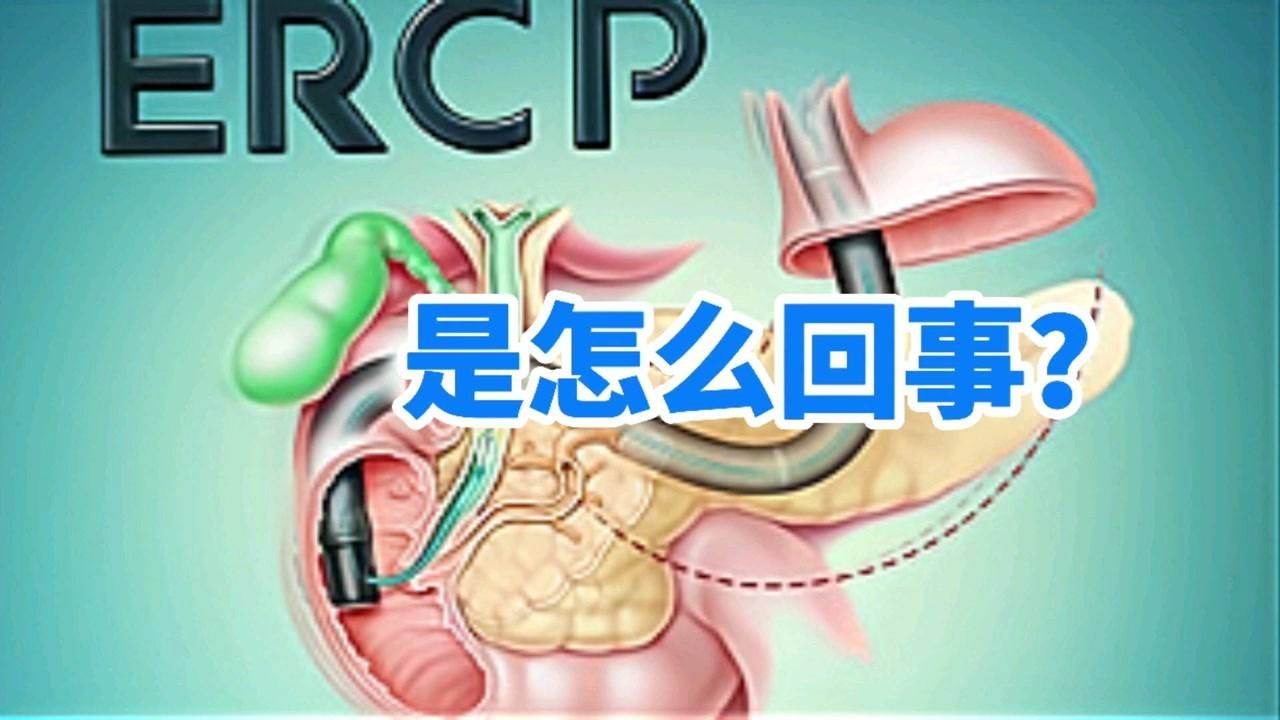 ERCP是什么意思_高清1080P在线观看平台_腾讯视频