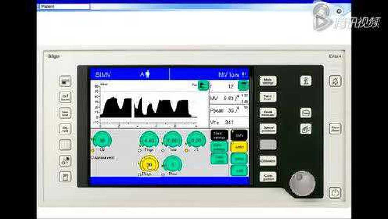 APRV与反比通气_腾讯视频
