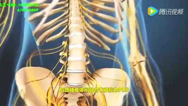 PLIF手术动画视频_腾讯视频