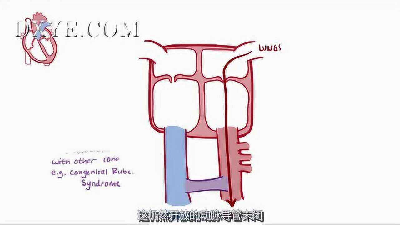 丁香叶医学健康科技专辑-2_动脉导管未闭PDA原因，症状，治疗和病理_高清1080P在线观看平台_腾讯视频