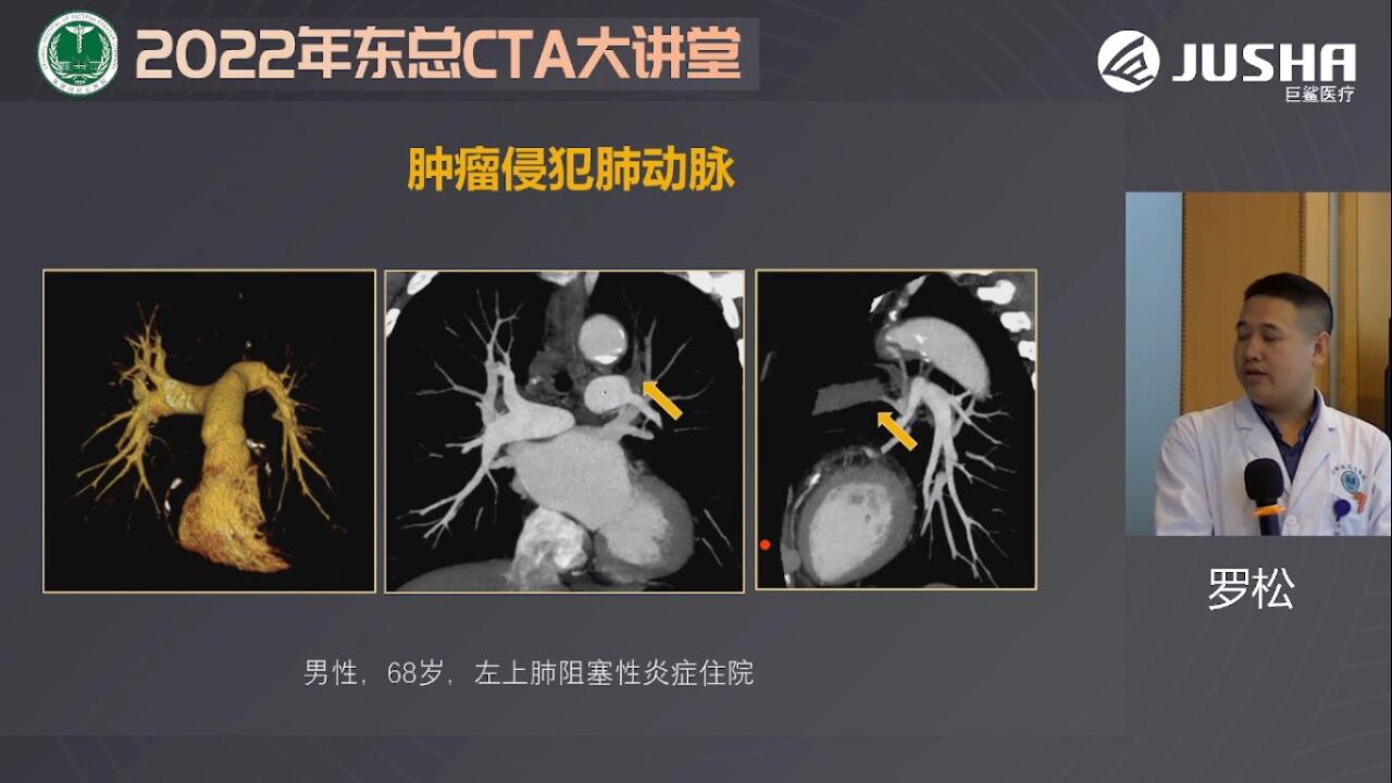 肺血管CTA扫描技术、后处理及诊断要点_东部战区总医院罗松_高清1080P在线观看平台_腾讯视频